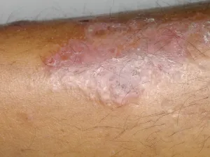 Tout savoir sur le prurit et le prurigo | Dermato-INFO