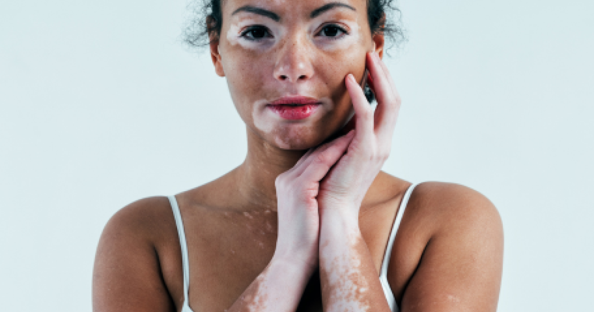 Vitiligo | Dermato-INFO