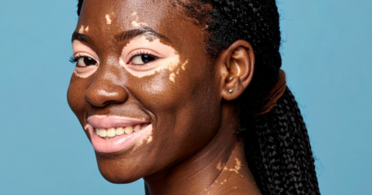 Connaitre les causes et examens du vitiligo | Dermato-INFO