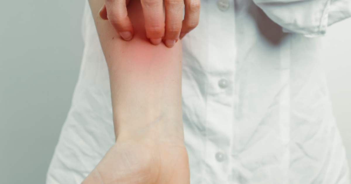 Tout savoir sur la gale | Dermato-INFO