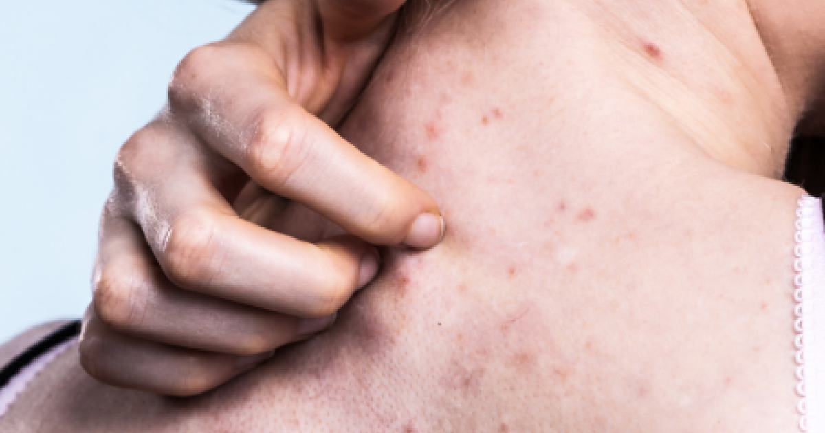 Comprendre l'acné | Dermato-INFO