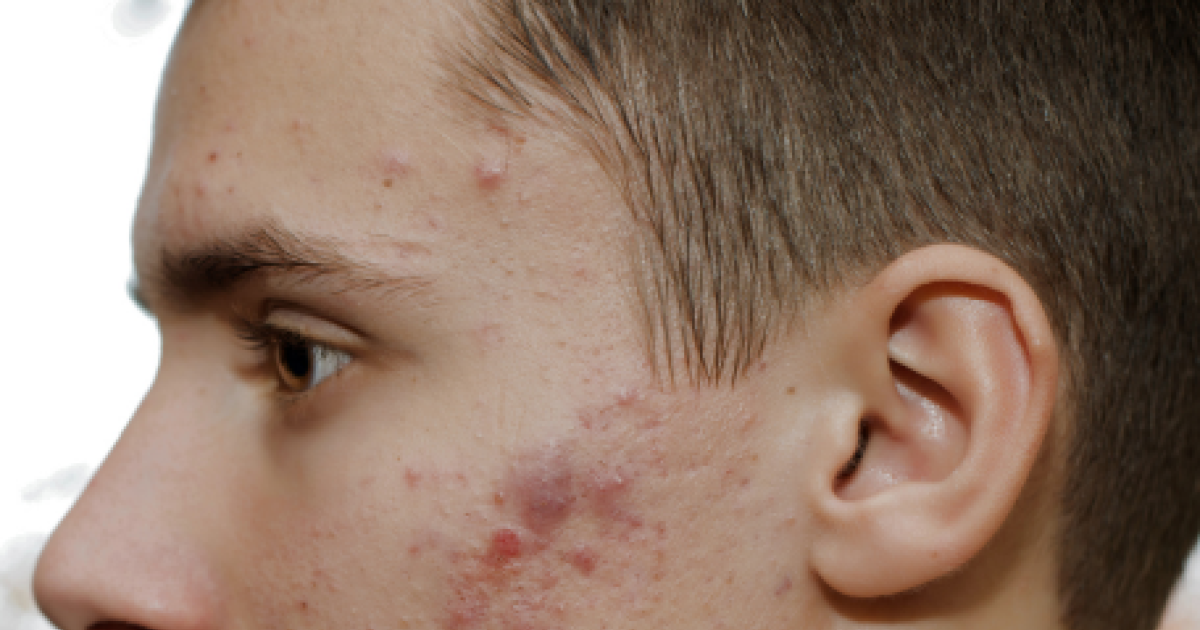 Acné | Dermato-INFO