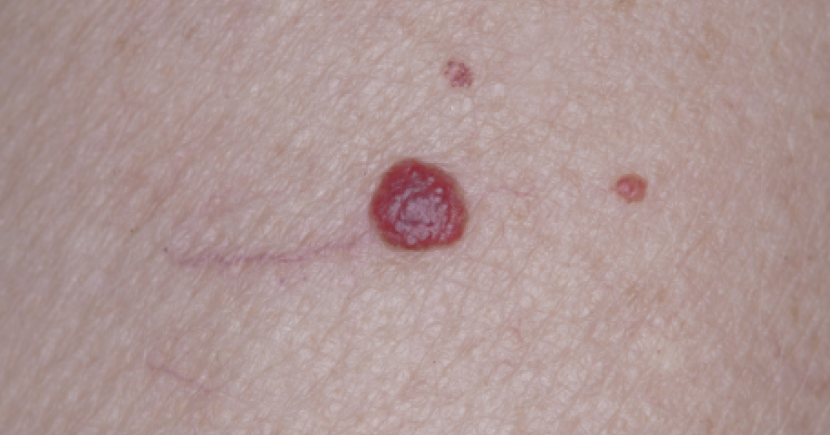 Angiomes | Dermato-INFO