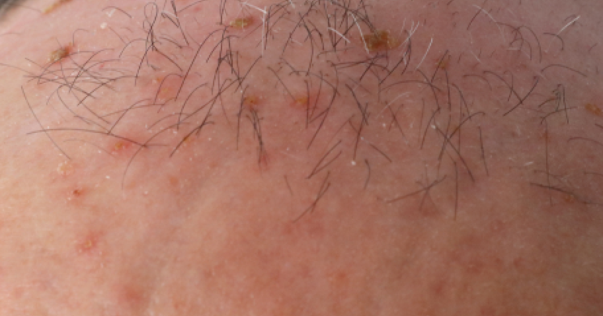 Tout savoir sur les kératoses actiniques | Dermato-INFO