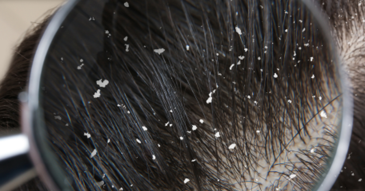 Comprendre les pellicules | Dermato-INFO