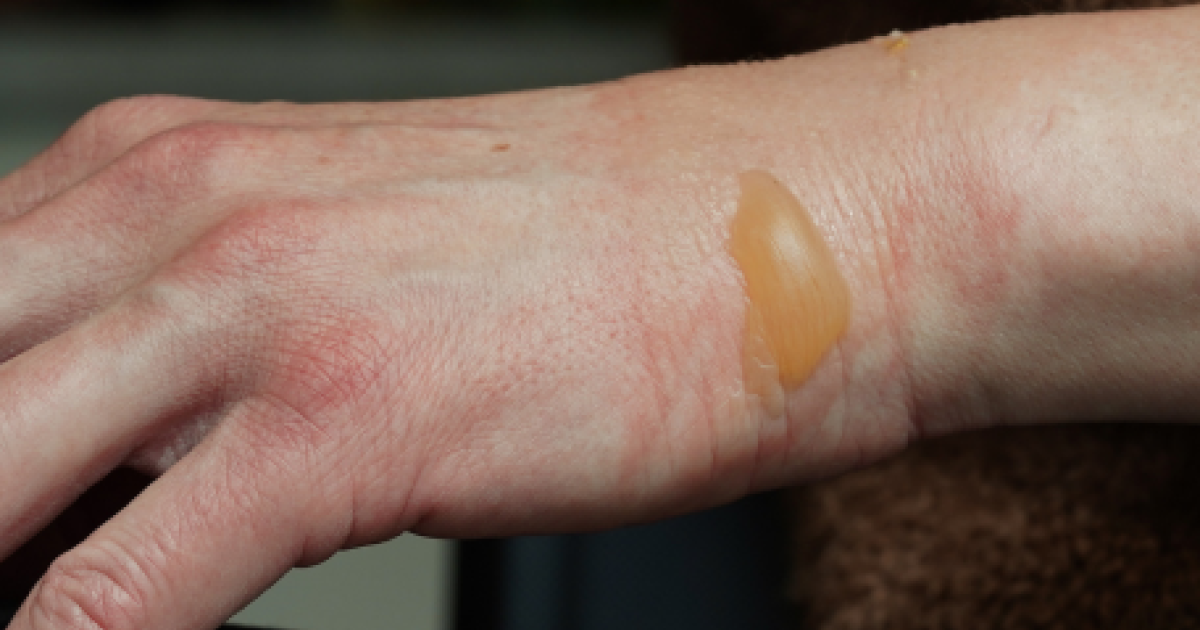 Fiches sur la pemphigoïde bulleuse | Dermato-INFO