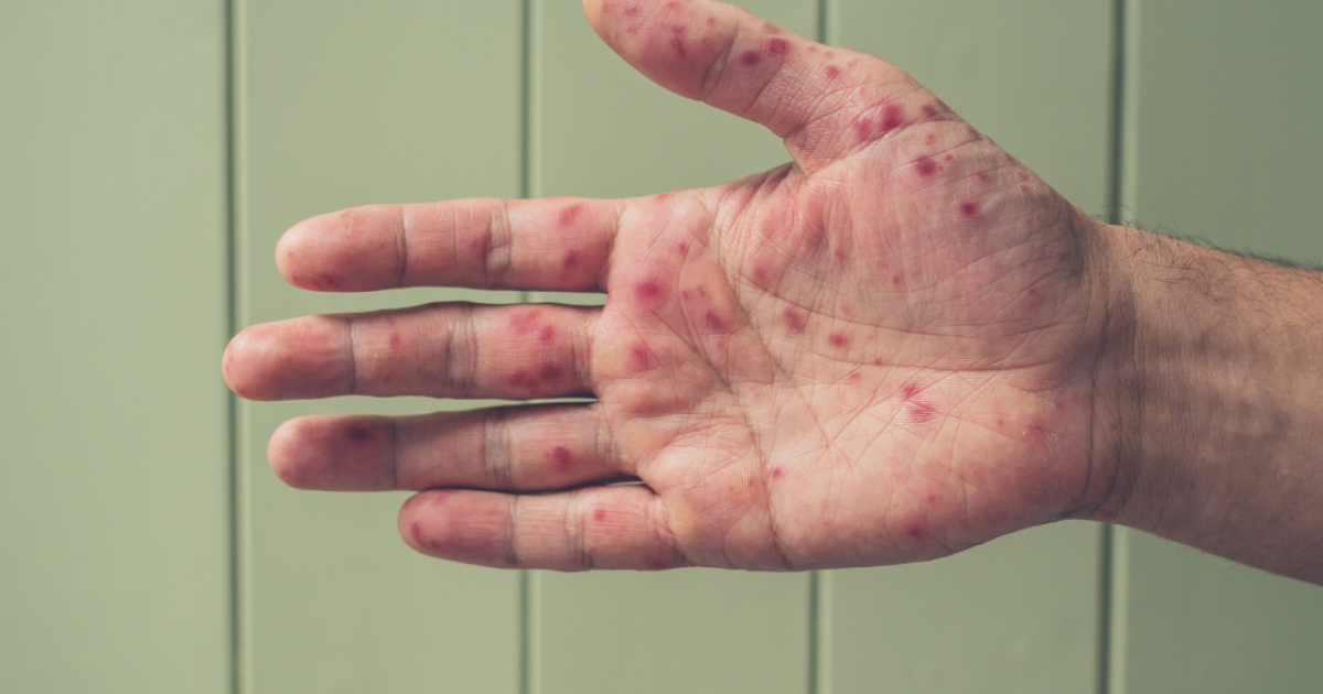 Comprendre la maladie pieds-mains-bouche | Dermato-INFO