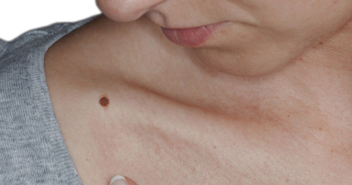 La méthode ABCDE | Dermato-INFO