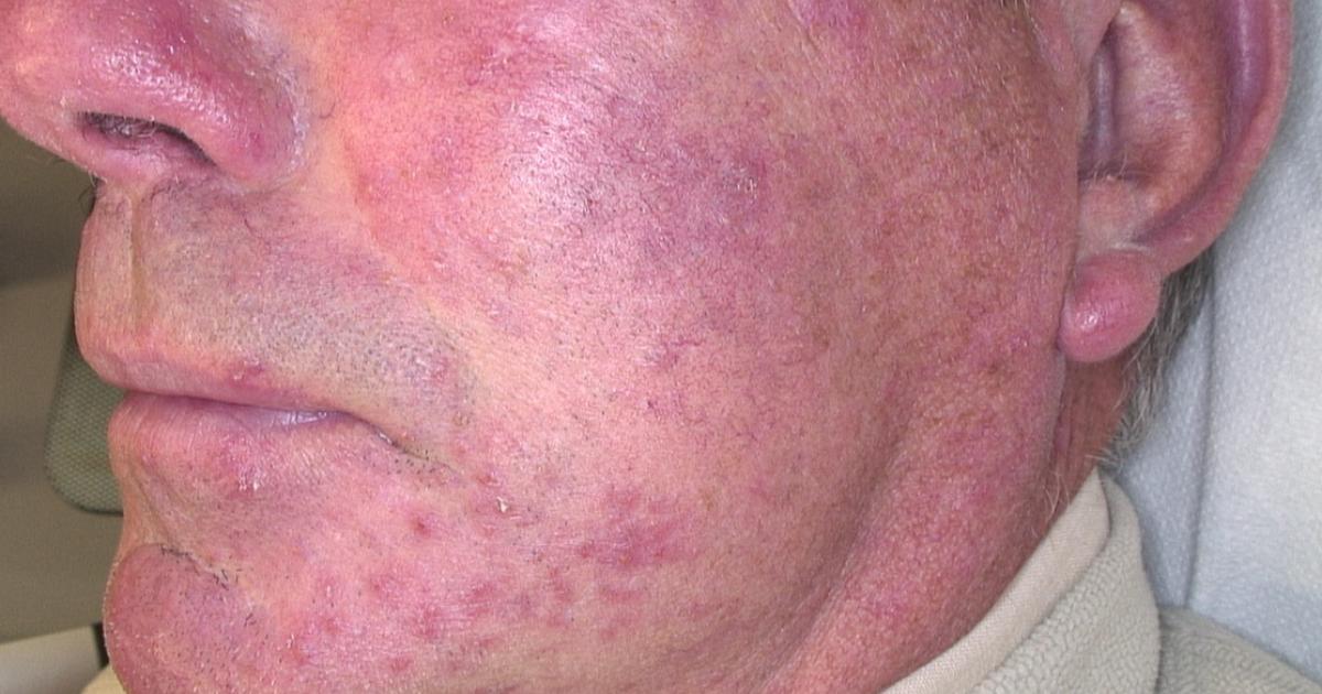Tout savoir sur la rosacée | Dermato-INFO