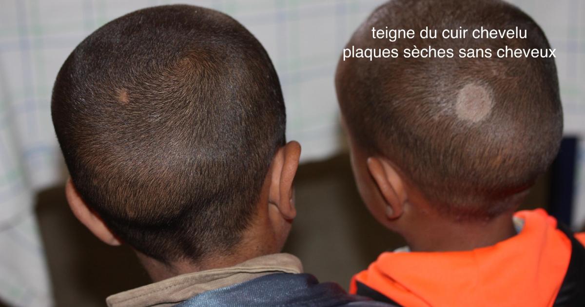 Teignes Dermato Info