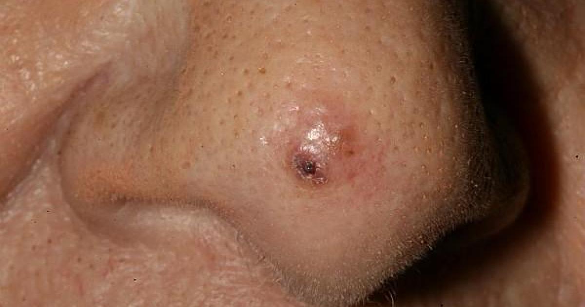 Carcinomes épidermoïdes cutanés | Dermato-INFO