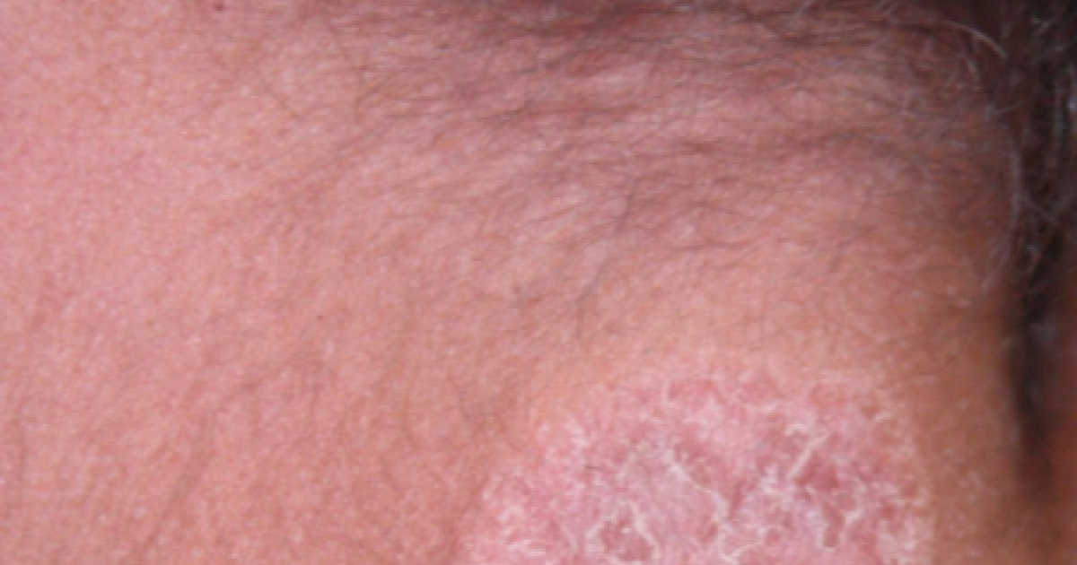 Mycoses cutanées | Dermato-INFO