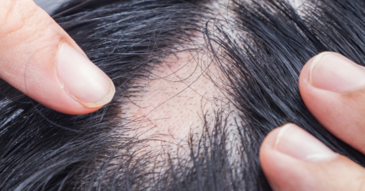 Pelade | Dermato-INFO