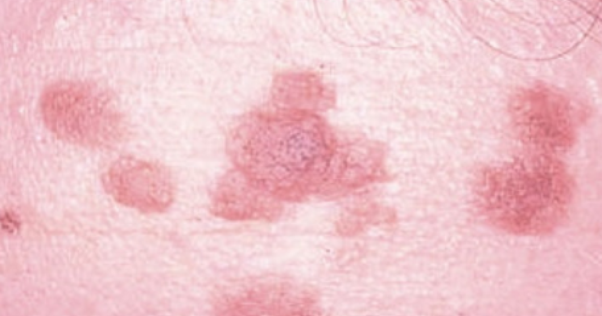 Connaitre les causes et examens des verrues | Dermato-INFO