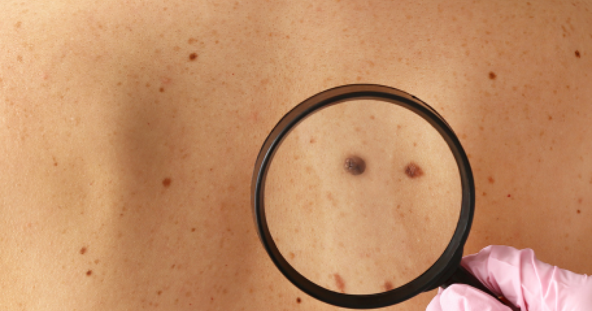 Surveiller sa peau : comment mieux dépister les lésions à risque ...