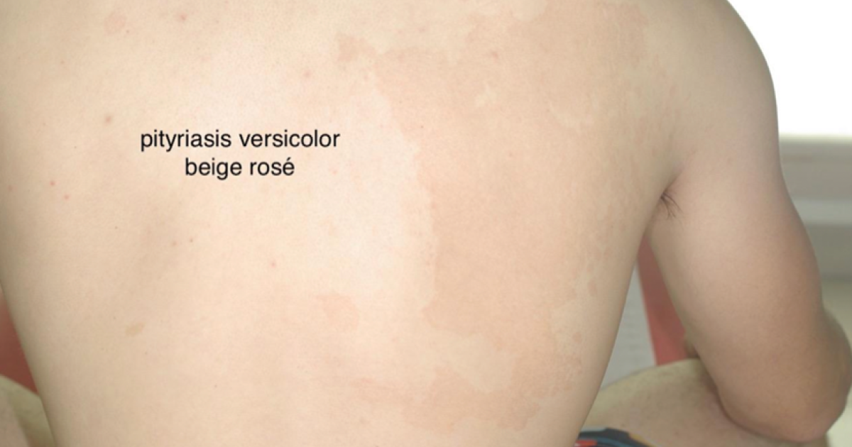 Pityriasis versicolor | Dermato-INFO